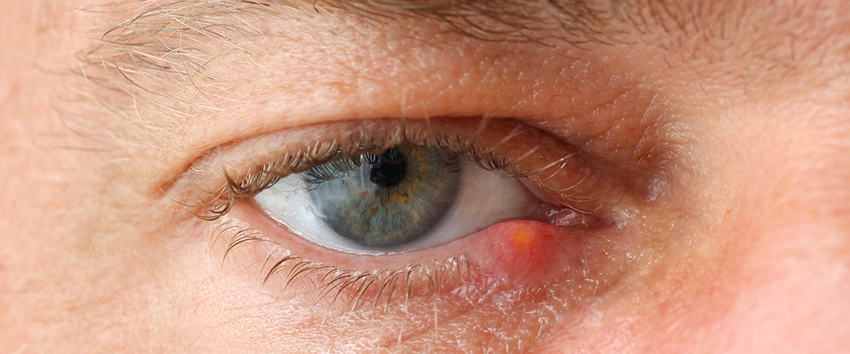 Gerstenkorn: Ursachen, Symptome und effektive Behandlungsmethoden ...